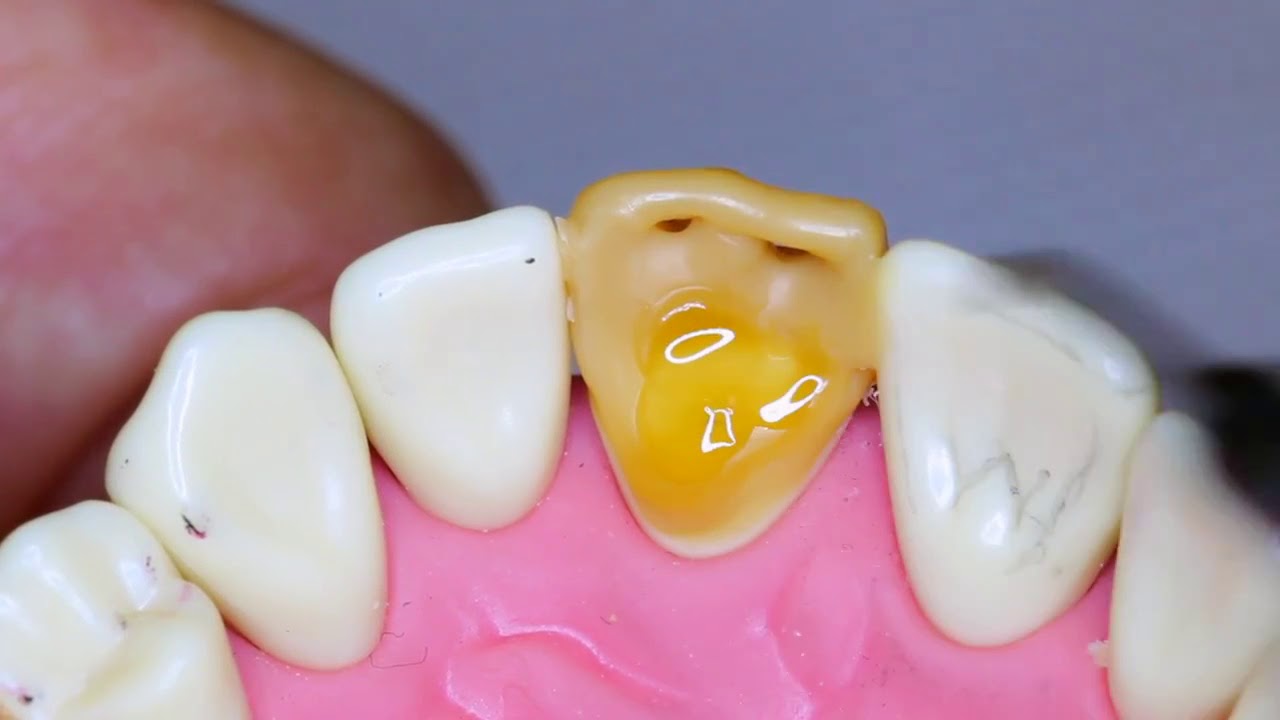 # Full Contour Wax Up - YouTube