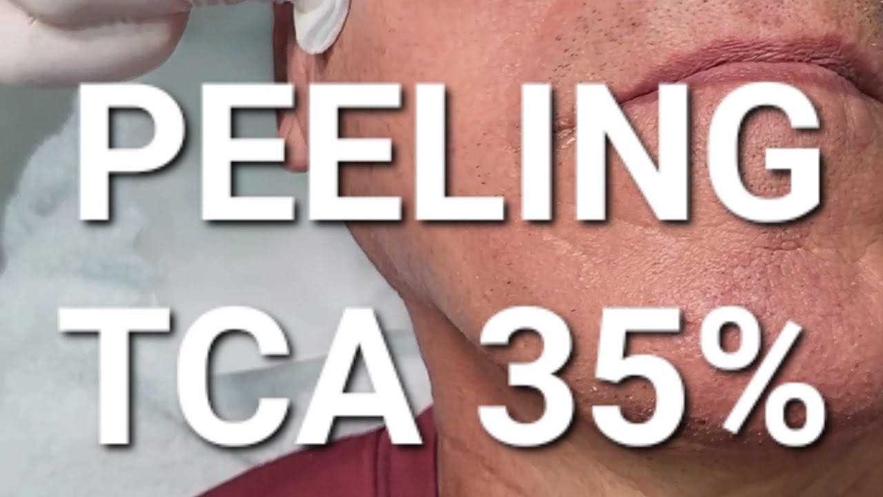 Peeling TCA 35% - YouTube
