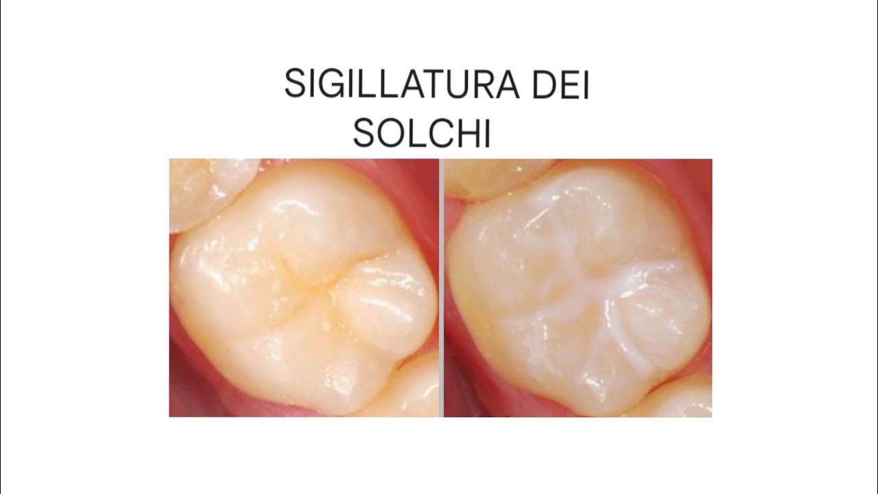 Sigillatura dei solchi - YouTube