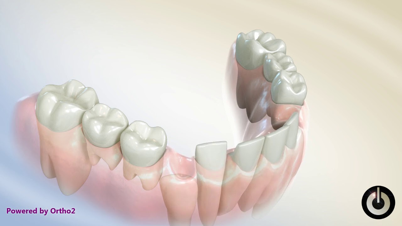 Lower Space Maintainer - Lower Lingual Holding Arch (LLA) - YouTube