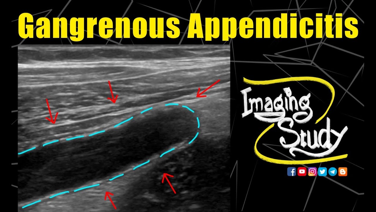 Gangrenous Appendicitis || Ultrasound || Case 229 - YouTube