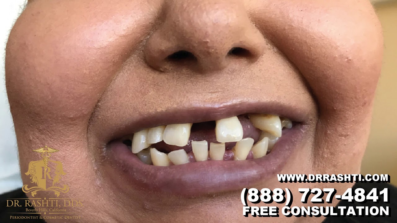 Dental Implant Before and After Pictures | Part 2 | Dr. Mahnaz Rashti ...