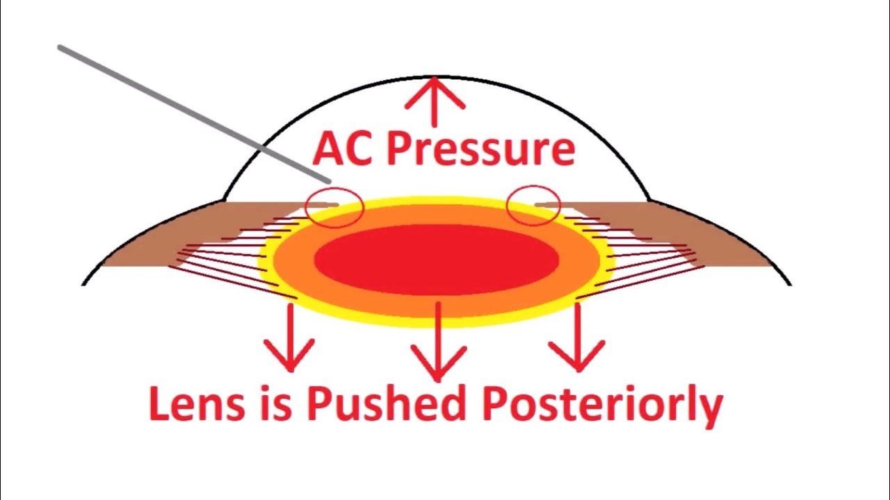 The Best Way To Do Cataract Surgery #36: Controlling Reverse Pupillary ...