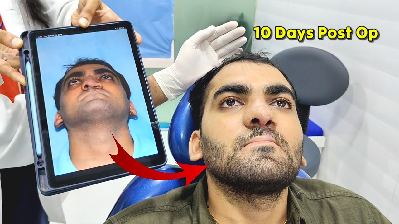 Amazing Rhinoplasty and Lip Revision Surgery Result | 10 Days Post Op ...