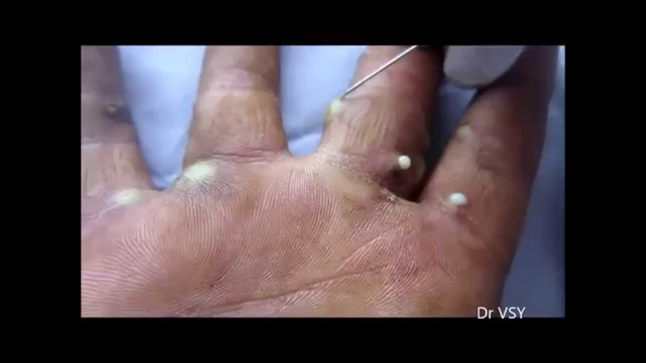 Pustules On Palm - YouTube