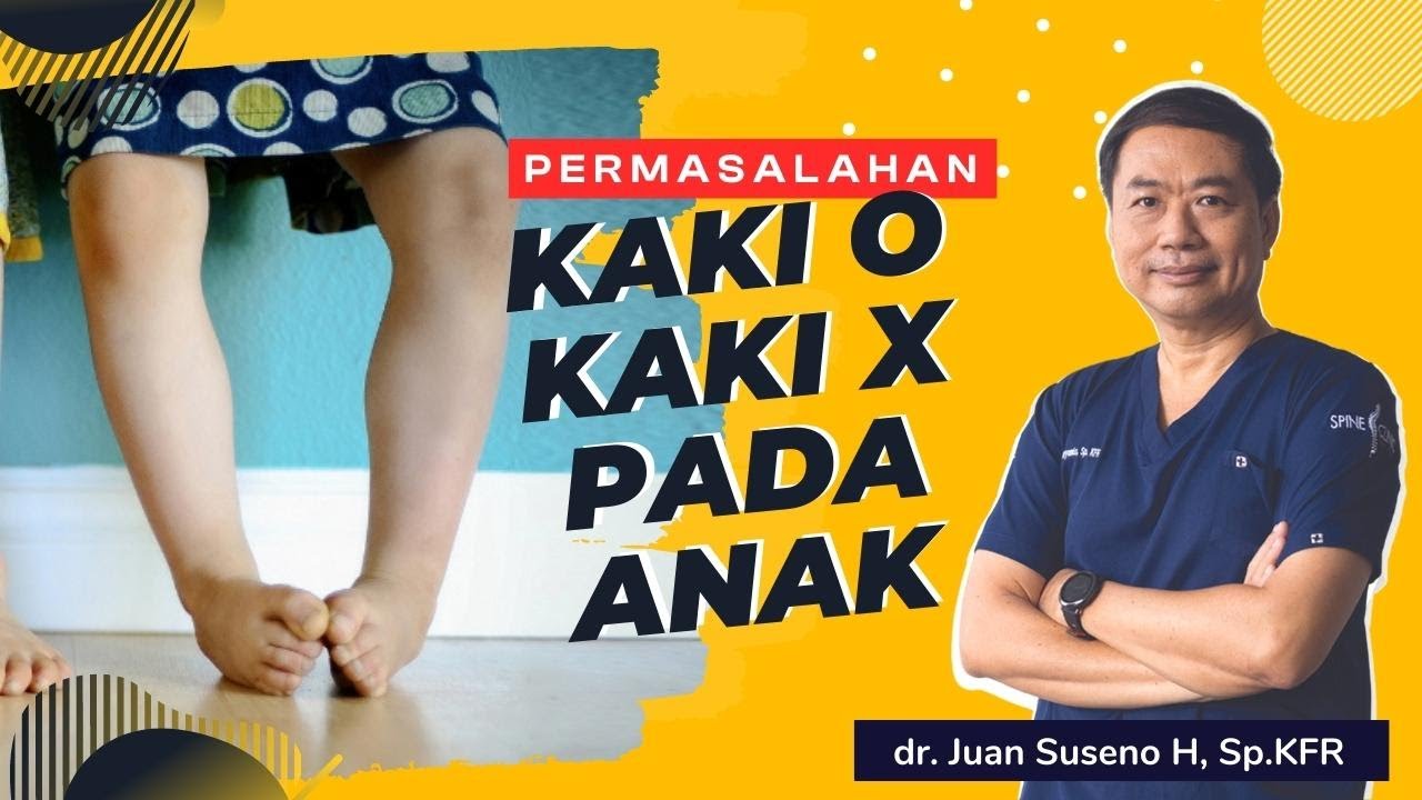Permasalahan Kaki O dan X Pada Anak - YouTube