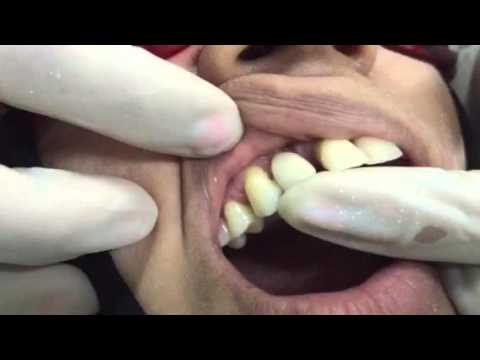 Mobility grade 3 of canine due to previous periodontitis and cantilever ...