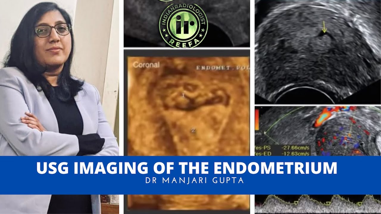 USG OF ENDOMETRIUM | DR MANJARI GUPTA | TVS SCAN PELVIS | SONOBUZZ ...