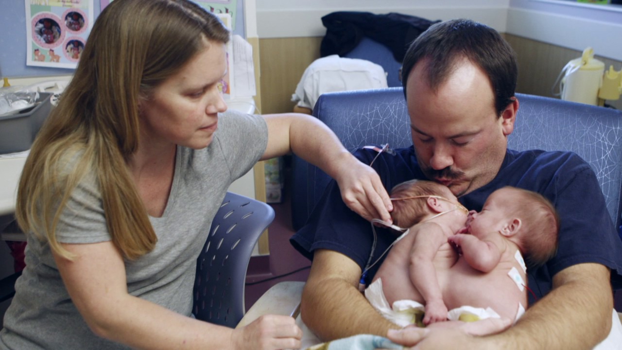 Conjoined Twin Babies