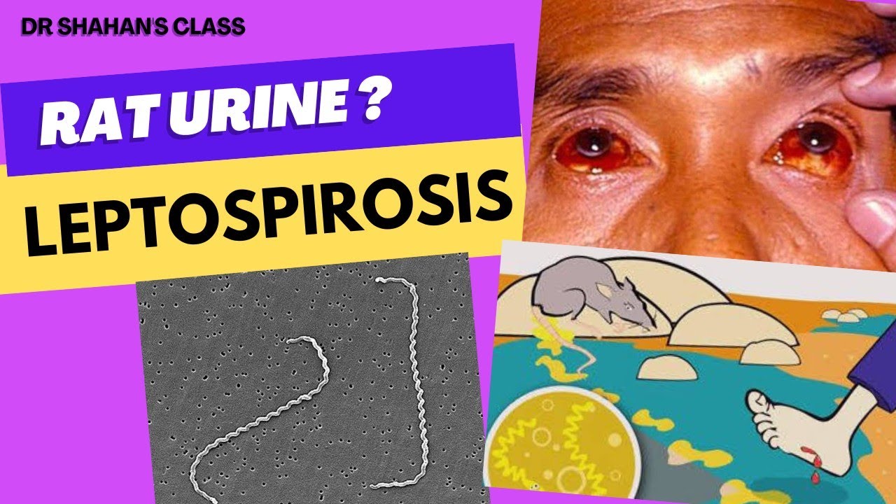 Leptospirosis | Symptoms | High yield points and image for FMGE, NEETPG ...