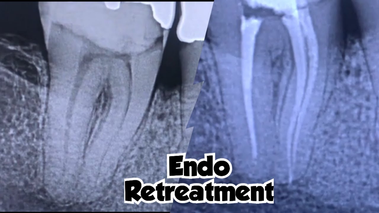 Evaluation of tooth number 31 || Root canal treatment - YouTube