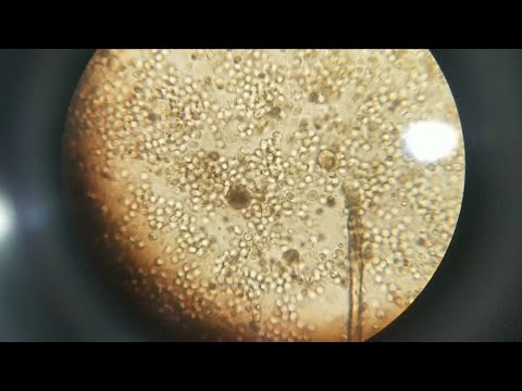 Pus Cells Over 100 in Urine Sample Under Microscope | Strep Of Urine ...