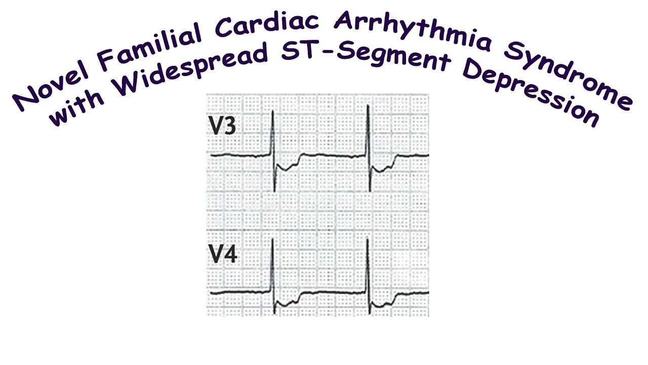 Novel Familial Cardiac Arrhythmia Syndrome: Bundgaard's syndrome - YouTube