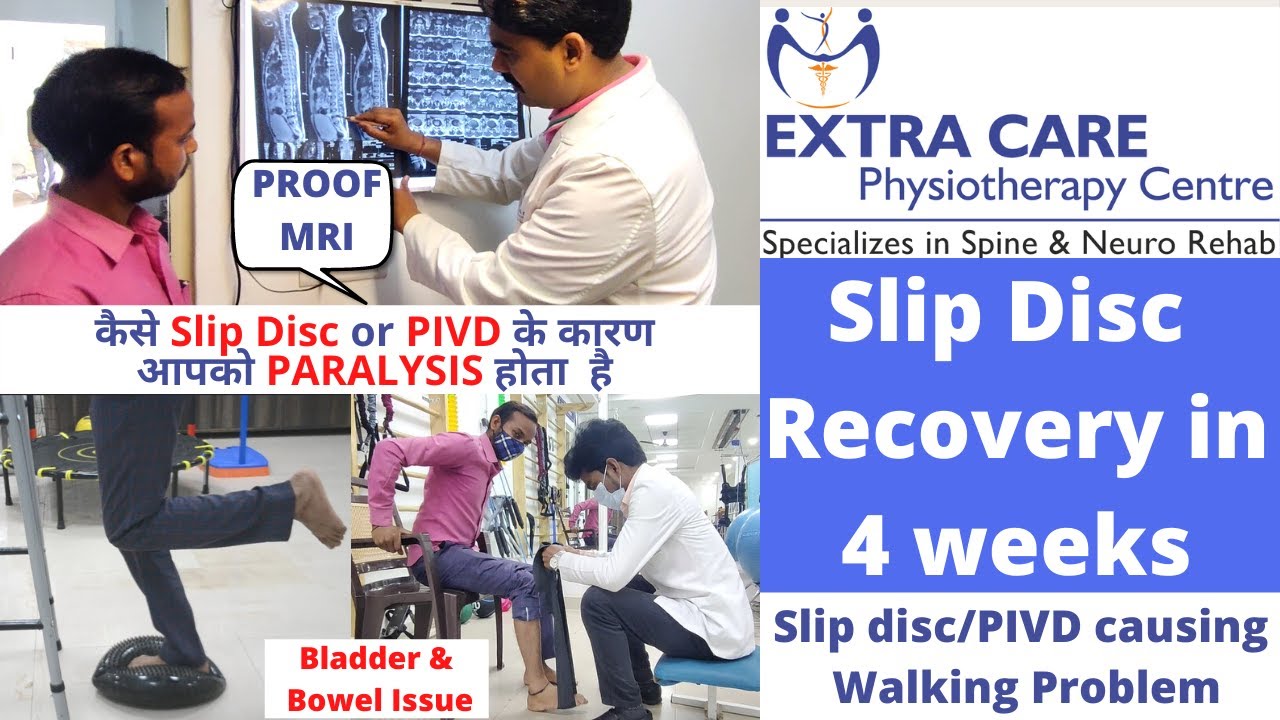 Slipped Disc 85% Recovery in 28 Days | Complete Walking after PIVD ...
