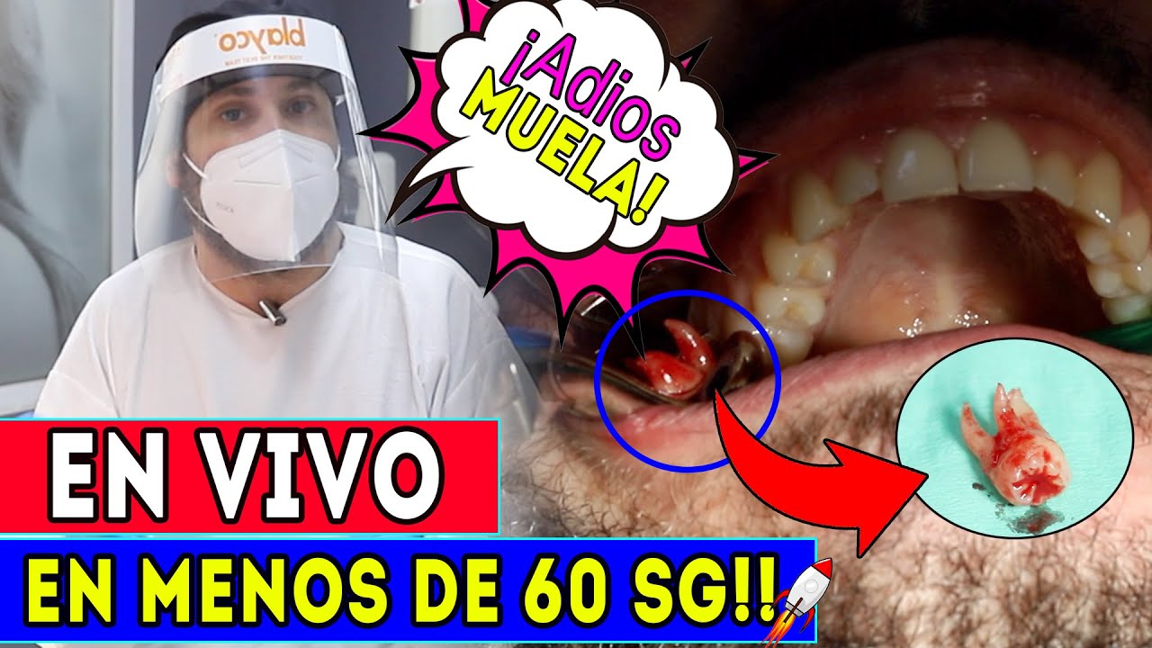 [En 𝐕𝐈𝐕𝐎🔴] Como se EXTRAE una MUELA del JUICIO en 𝗠𝗘𝗡𝗢𝗦 𝗱𝗲 𝟲𝟬 𝘀𝗴! (🚀 ...