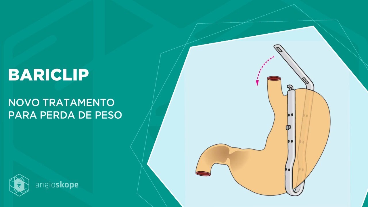 BARICLIP: TUDO que você PRECISA SABER sobre a nova técnica de ...