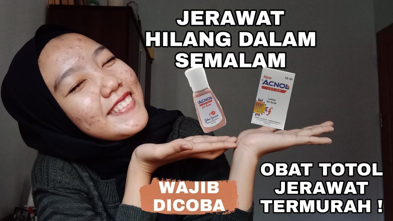 REVIEW ACNOL LOTION | JERAWAT HILANG DALAM SEMALAM | OBAT JERAWAT ...