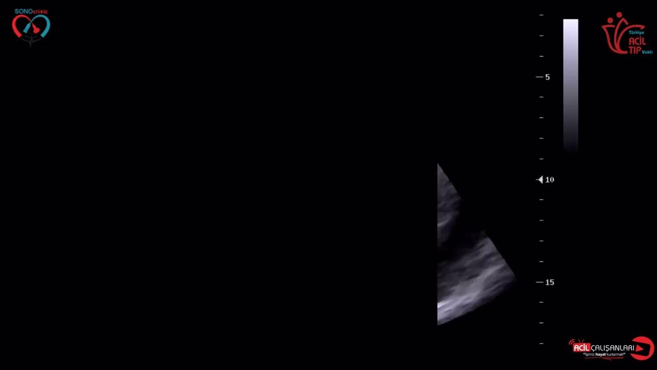 Focused Assessment With Sonography in Trauma (FAST) - YouTube