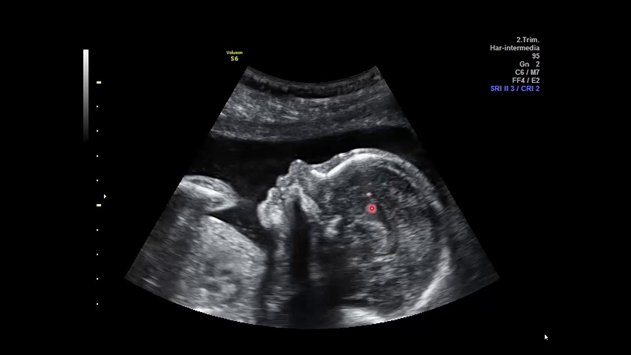 Ecografía De Paladar Hendido 20 Semanas Ecografías 4d Clinica Parc