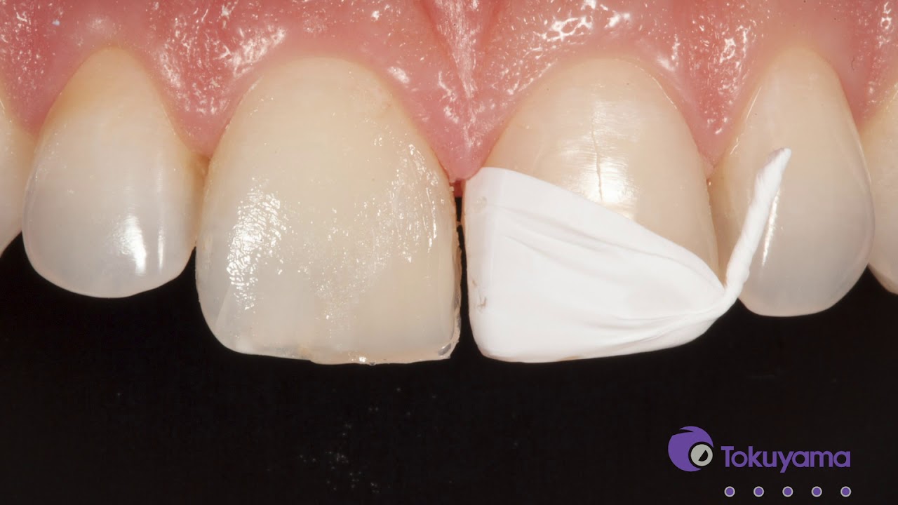 Tokuyama Palfique Omnichroma I Case #5 Class IV Fracture Tooth With ...