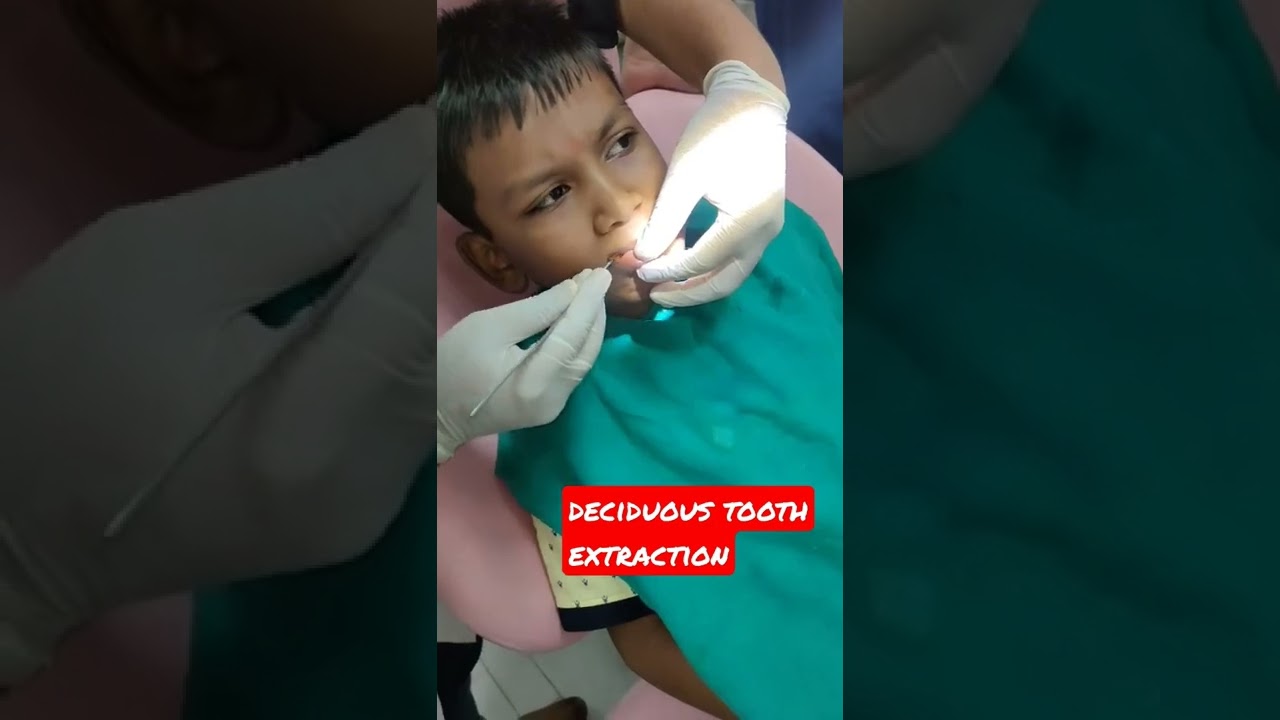 Deciduous tooth Extraction|Milk tooth Extraction - YouTube