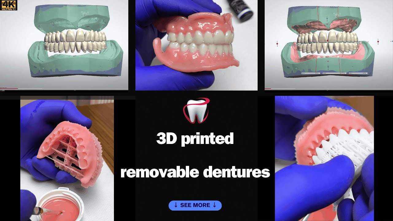 3D printed removable dentures - YouTube