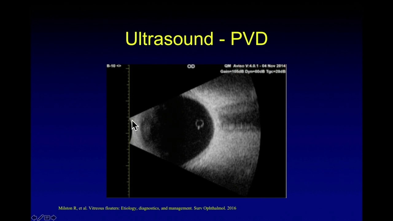 Posterior Vitreous Detachment - YouTube