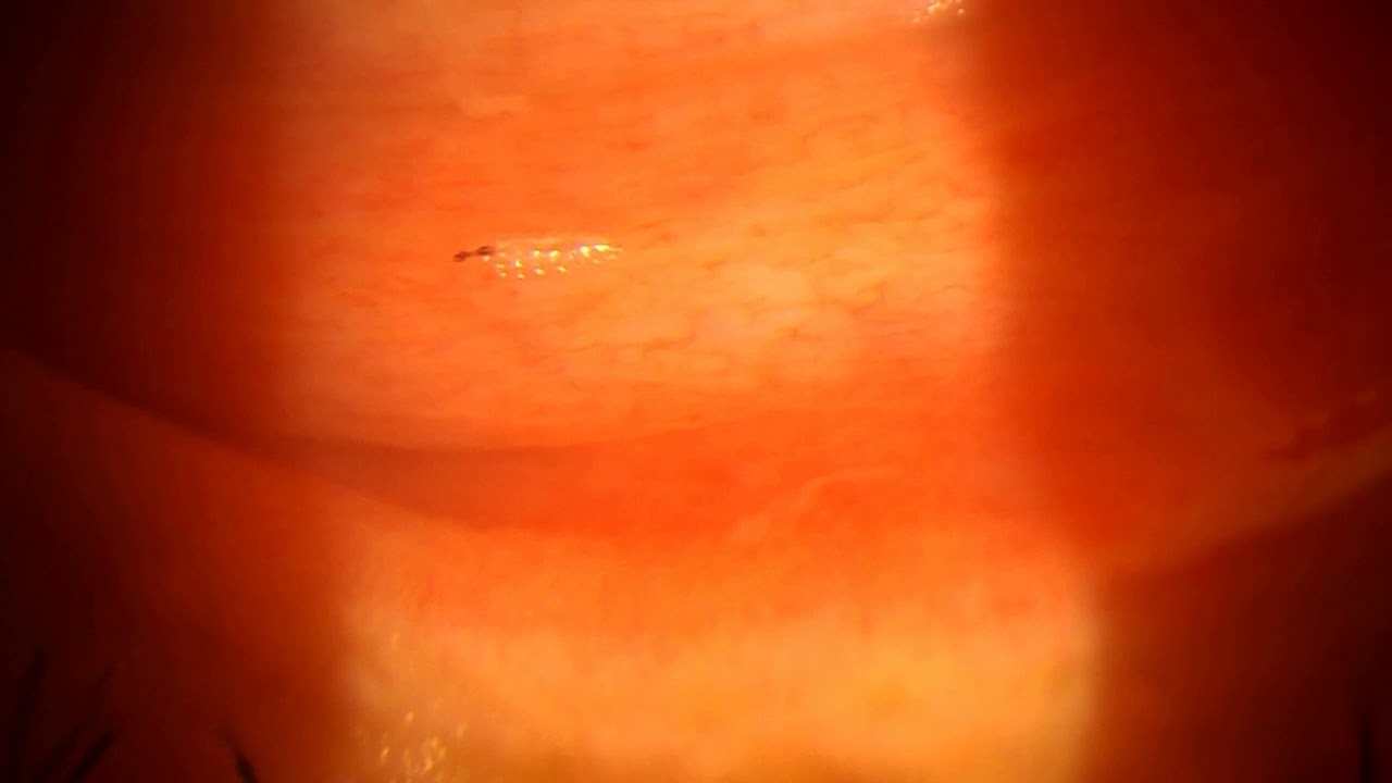 Ocular Myiasis - YouTube