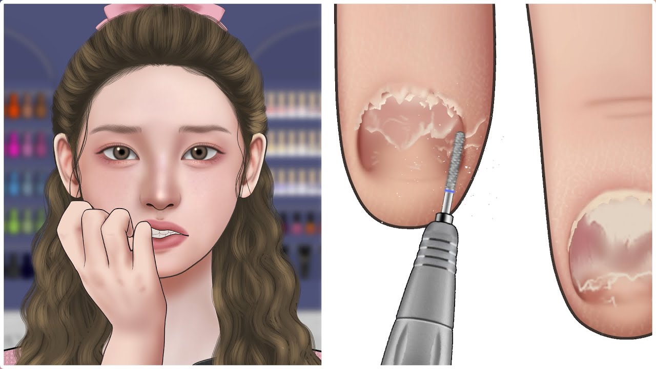 [ASMR]심하게 물어뜯은 손톱 복구 애니메이션 / Biting Nail Recovery Animation - YouTube