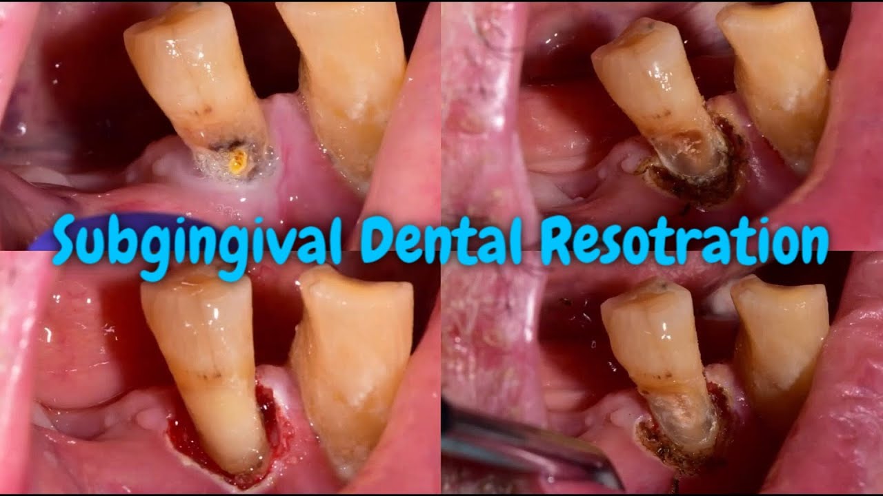 [96] Deep Class 5 Dental Restoration - YouTube