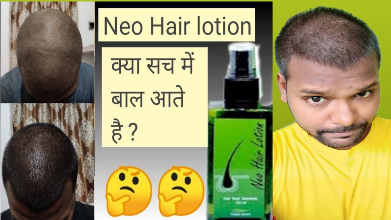 Neo Hair Lotion Review With Results ||#neohairlotion # ...