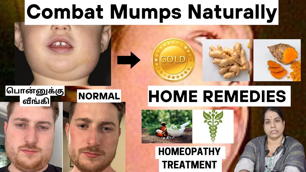பொன்னுக்கு வீங்கி Natural Solutions for Mumps: Homeopathy & Home ...