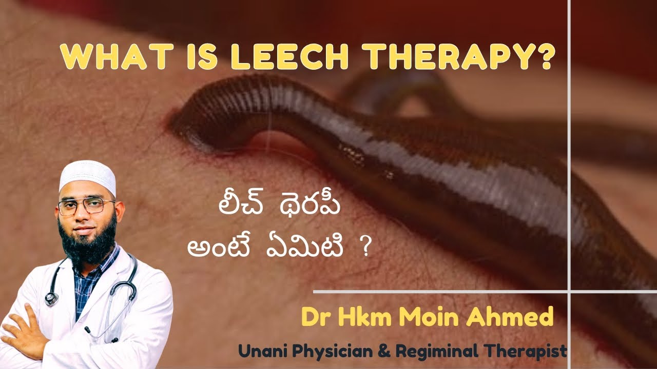 what is leech therapy?? లీచ్ థెరపీ అంటే ఏమిటి?? - YouTube