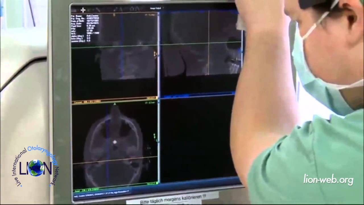 Hannover Otology Update 2015 Intraoperative CT Scan after cochlear ...