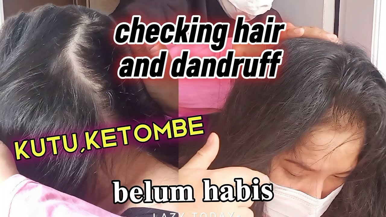 Checking hair and Dandruff,kutu,ketombe belom habis @Arimmybeauti34 ...