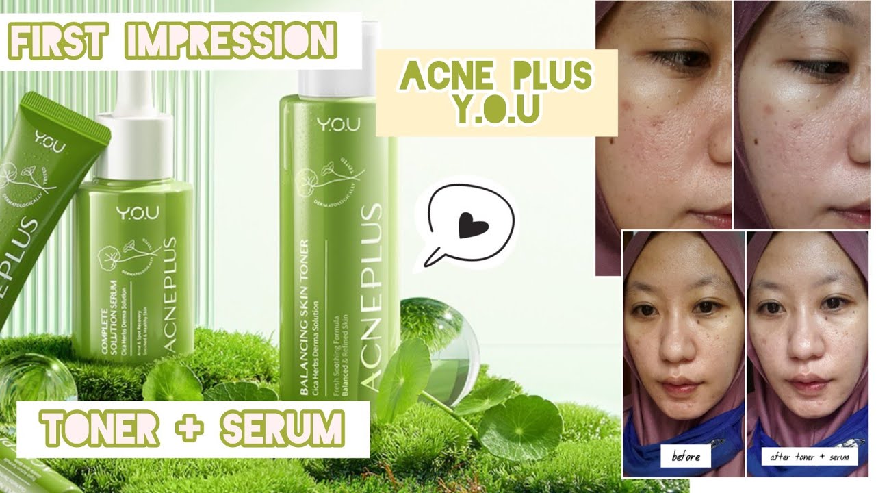 Bebas Jerawat Pakai Skincare Y O U Acneplus Di Kulit Berjerawat Dan