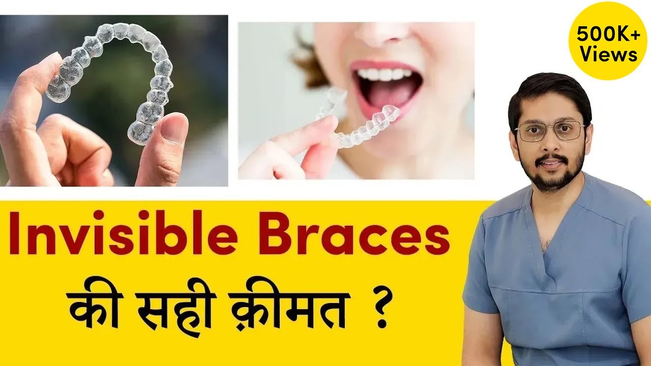 Invisible braces (dental aligners) ki sahi price | Cost of aligners in ...