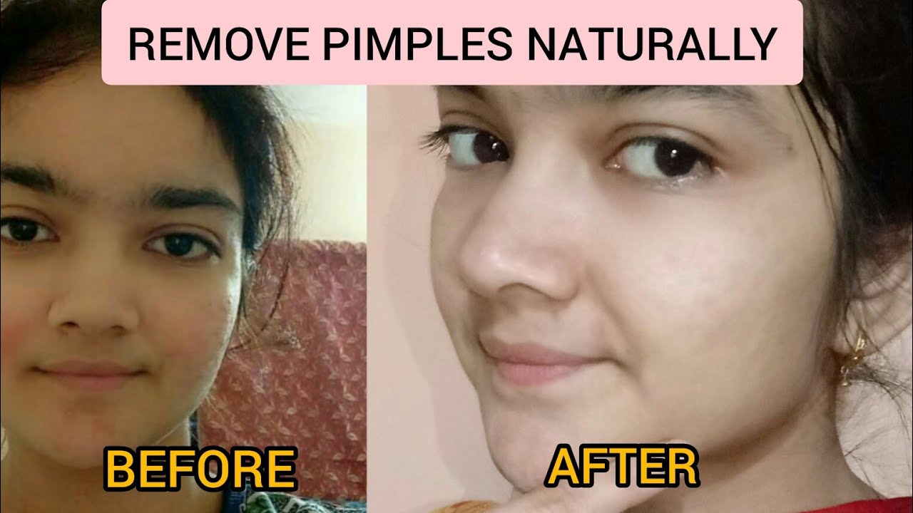 HOW TO REMOVE PIMPLES ll Cure Acne using this DIY face mask ll 🌸 - YouTube