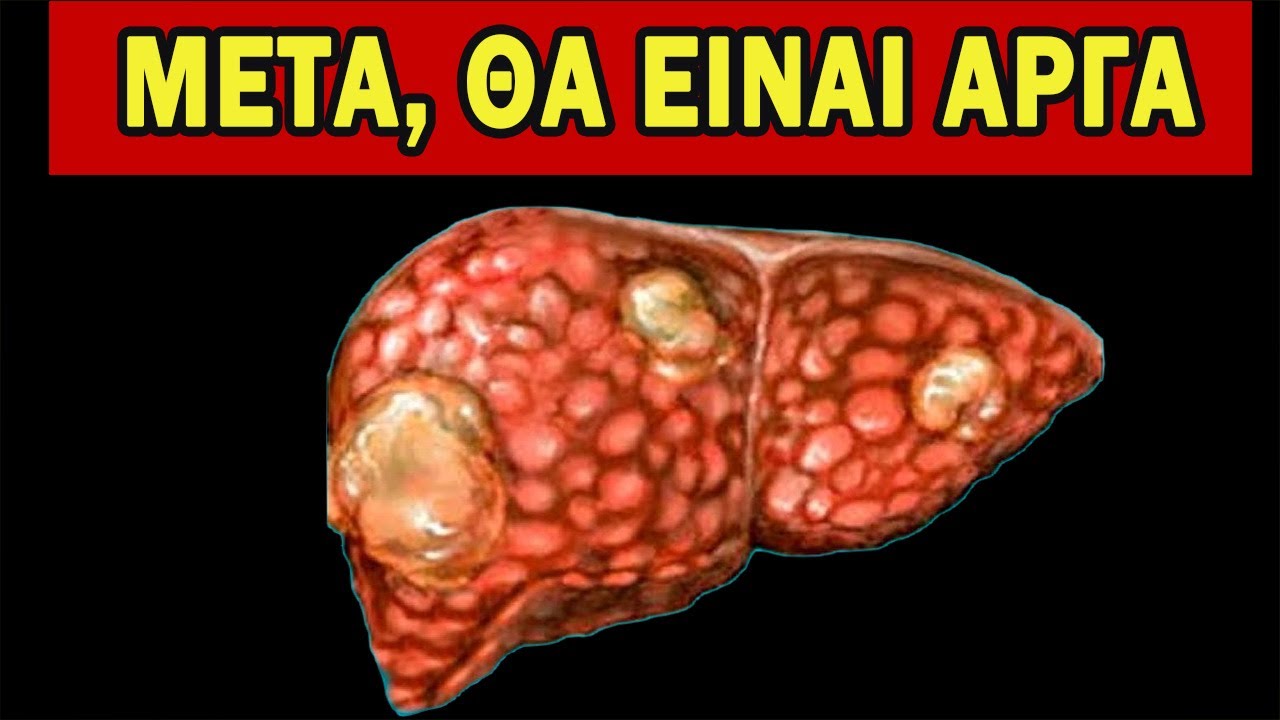 💡 Έντονα Σημάδια Για Πάθηση Στο Συκώτι! | Ακαδημία Υγείας - YouTube
