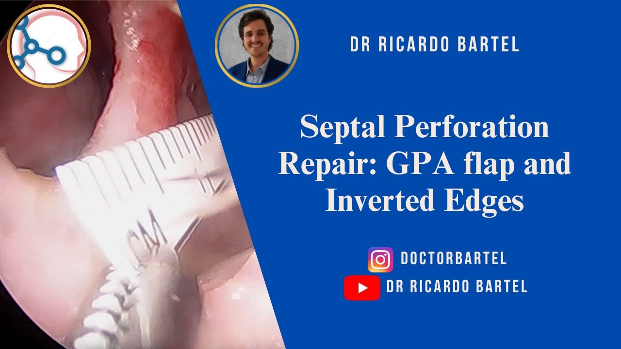 Septal Perforation Repair with Greater Palatine Artery (GPA) Flap and ...