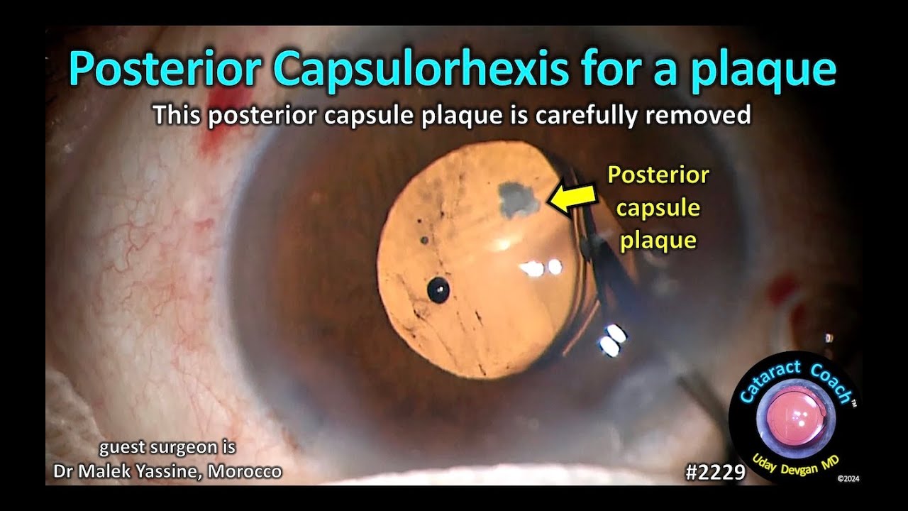 CataractCoach™ 2229: posterior capsulorhexis for a plaque - YouTube