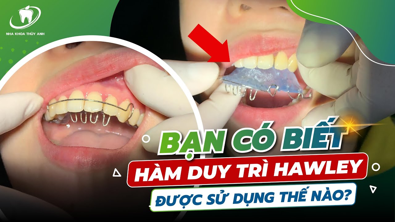 HÀM DUY TRÌ HAWLEY kết hợp KHÍ CỤ CHỐNG ĐẨY LƯỠI - DUY TRÌ KẾT QUẢ SAU ...