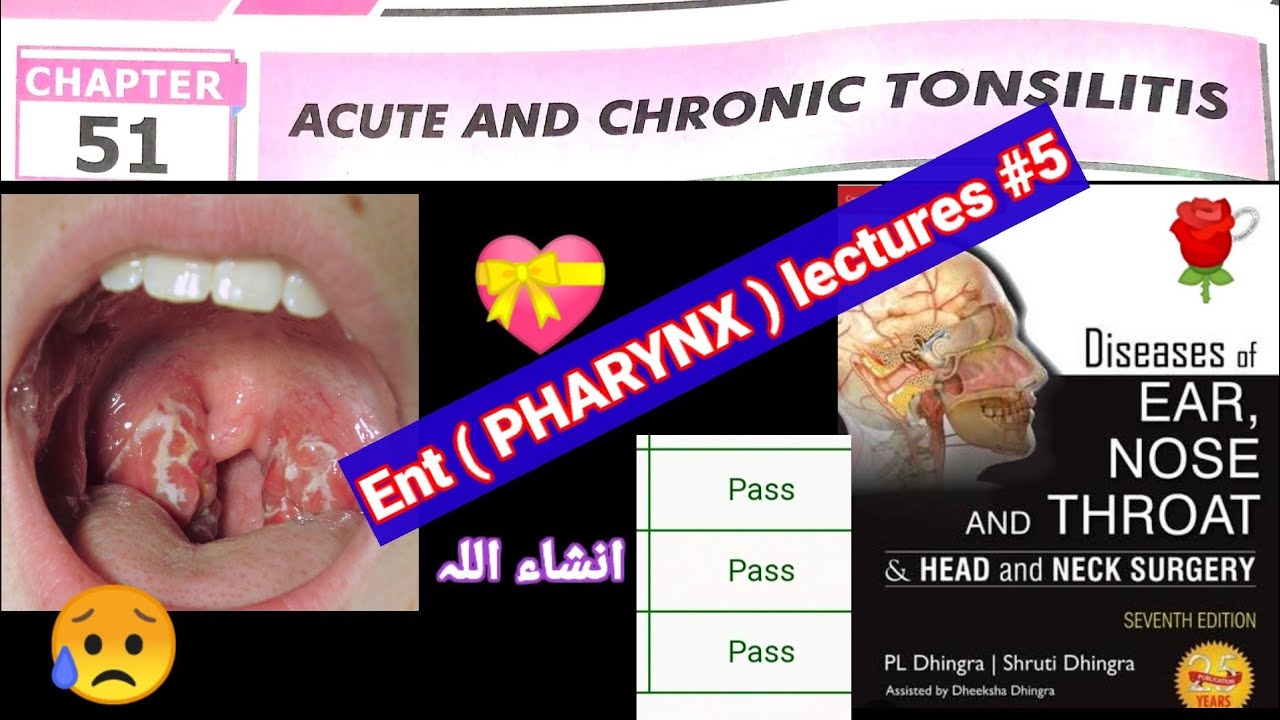 🔴🔴 Acute and chronic Tonsillitis lectures #5 #ENT (PHARYNX). blood ...