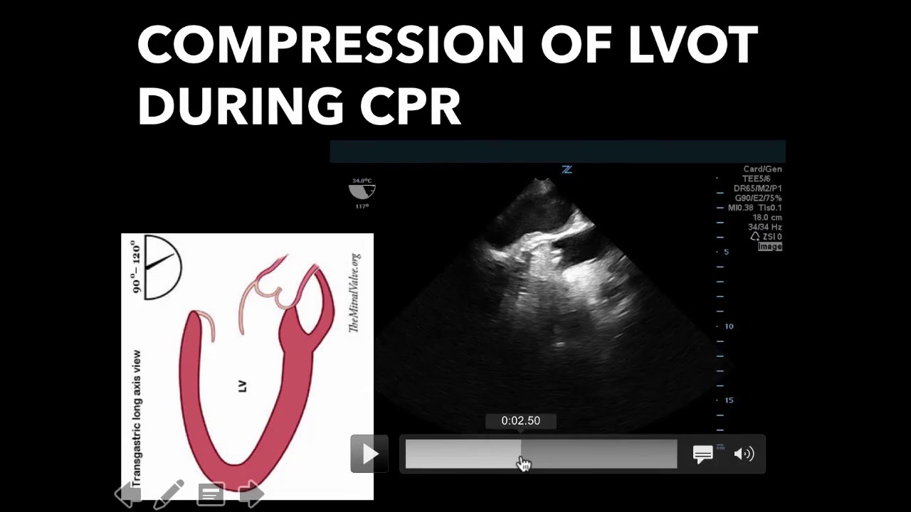 EMCrit Podcast 208 - You are Doing CPR All Wrong - YouTube
