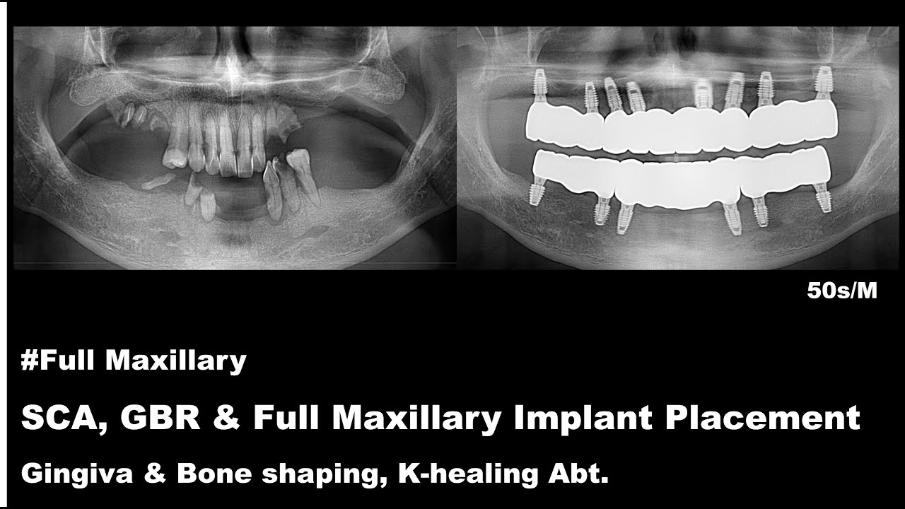 #Full Maxillary SCA & Implant Placement (Gingiva & Bone shaping, GBR, K ...