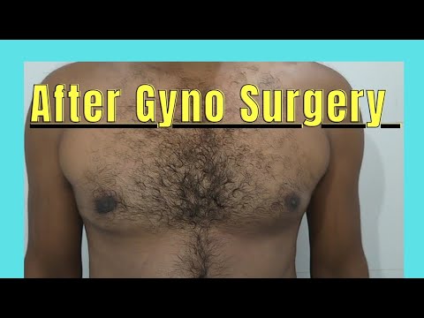 Perfect chest shape after Gynecomastia surgery | Scarless Gynecomastia ...