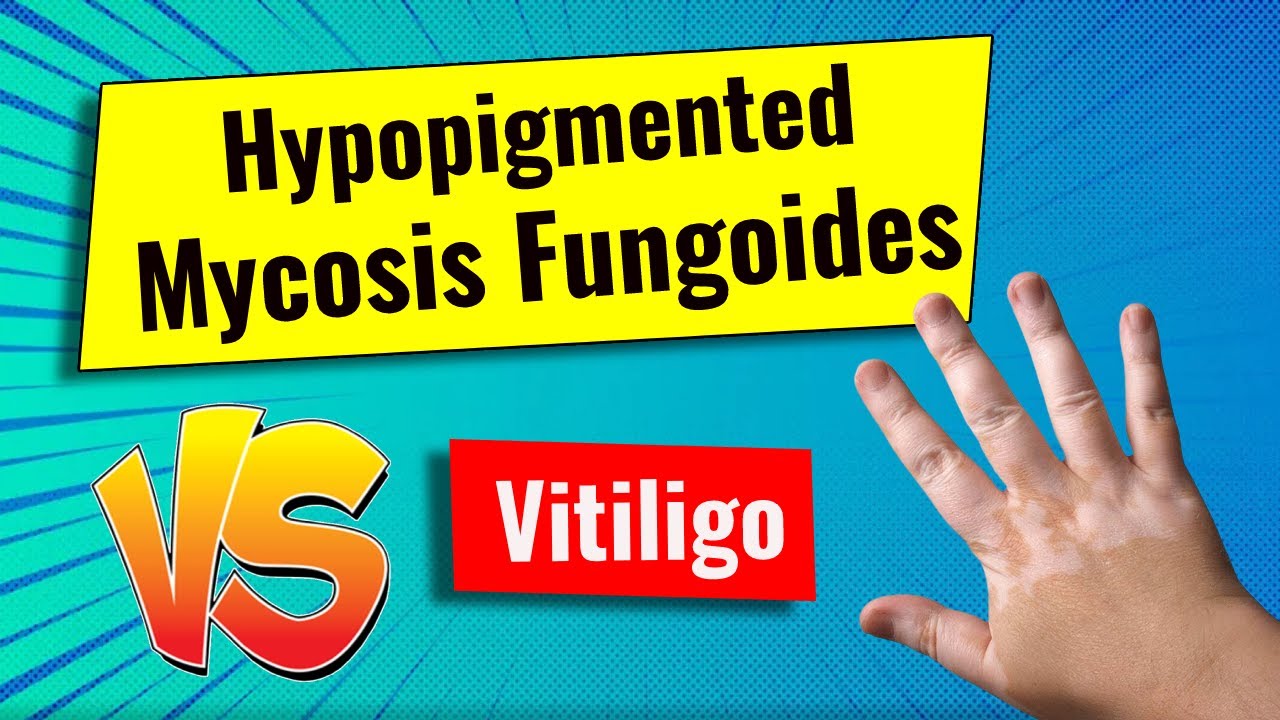 Vitiligo confused with skin lymphoma?? how to differentiation between ...