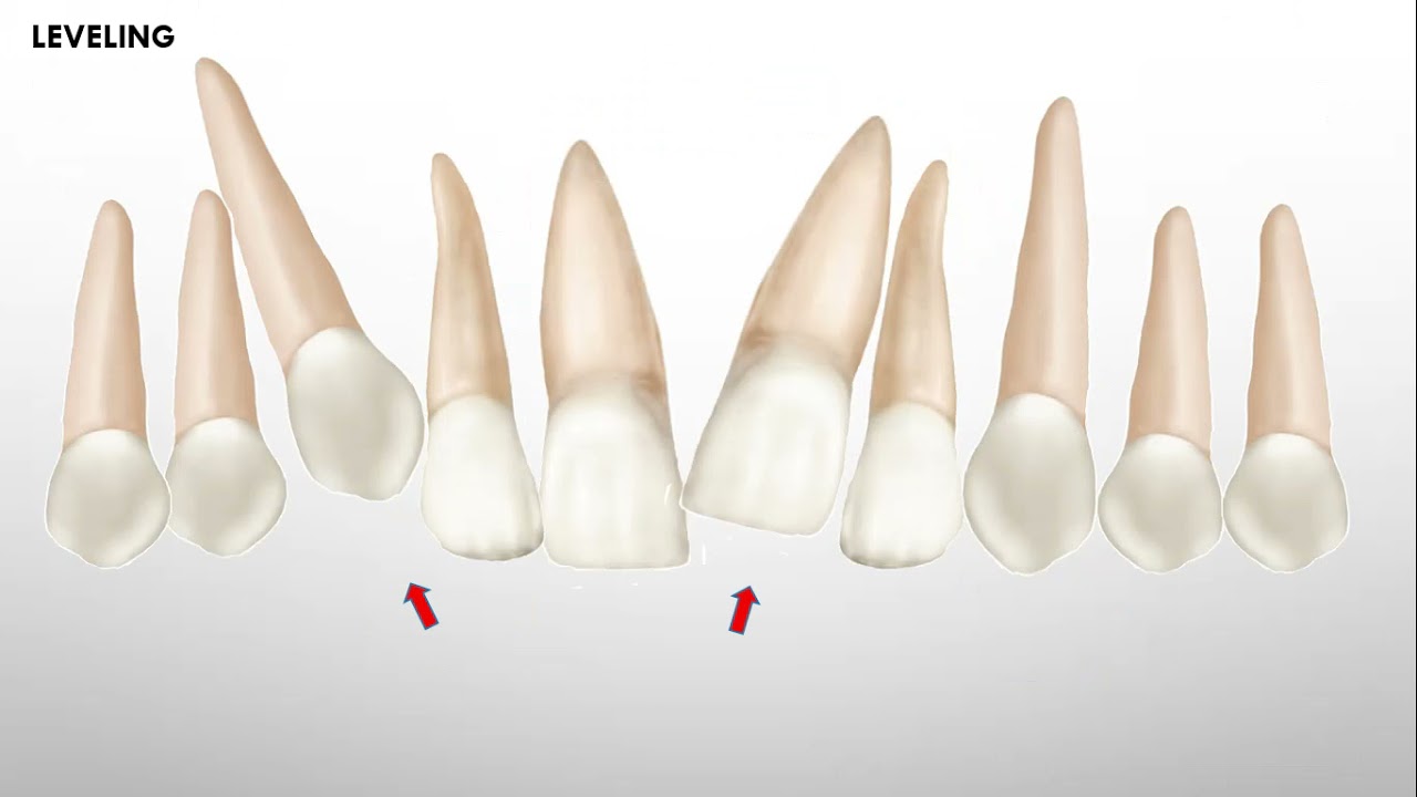 first order, second order, third order bends. part 1 (how does fixed ...