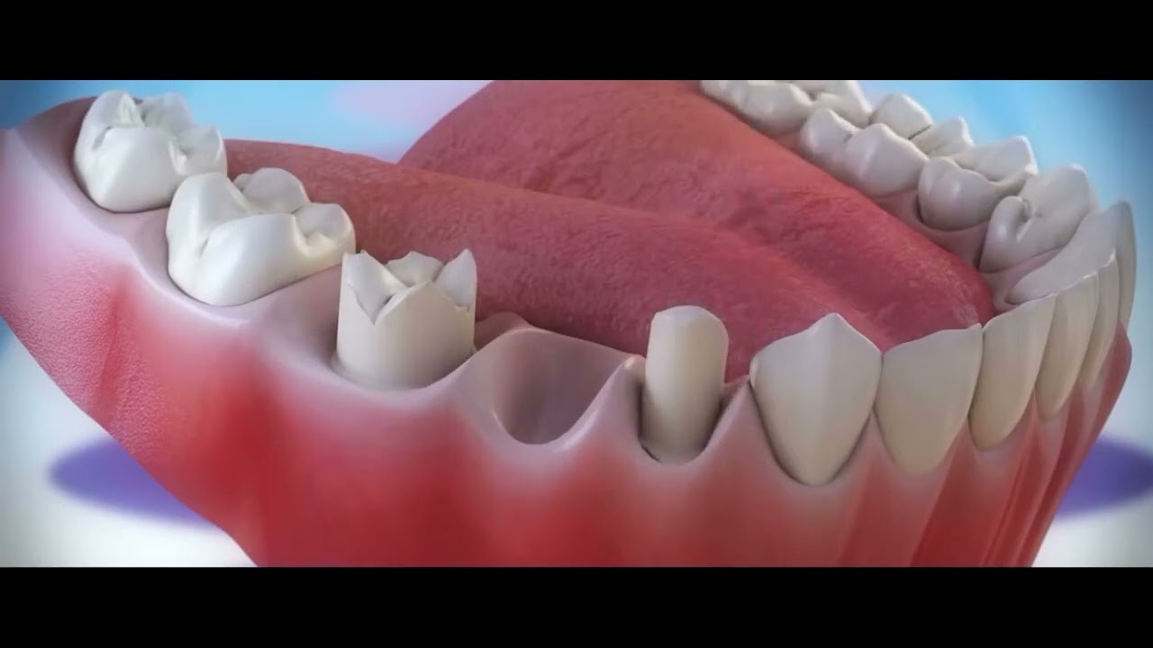 Réalisation d'un bridge dentaire - YouTube