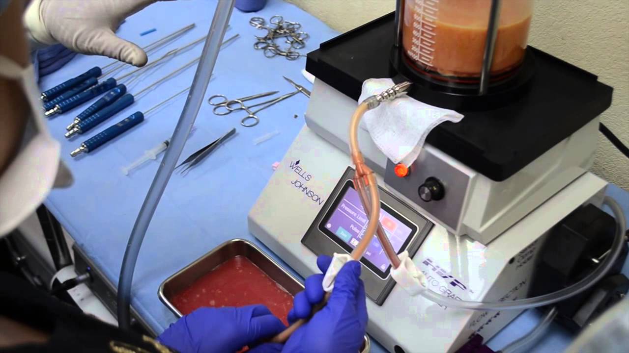 Fat transfer from abdomen and hips to buttock - YouTube